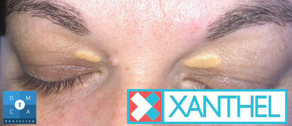 Xanthelasma Pictures And Images | XANTHEL