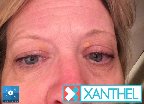 Xanthelasma Pictures And Images | XANTHEL